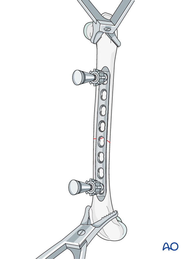 Compression plate for Simple transverse fractures of the femoral diaphysis