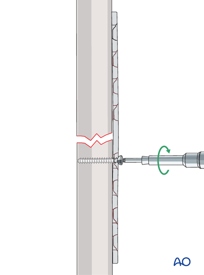 Compression plate for Simple transverse fractures of the femoral diaphysis
