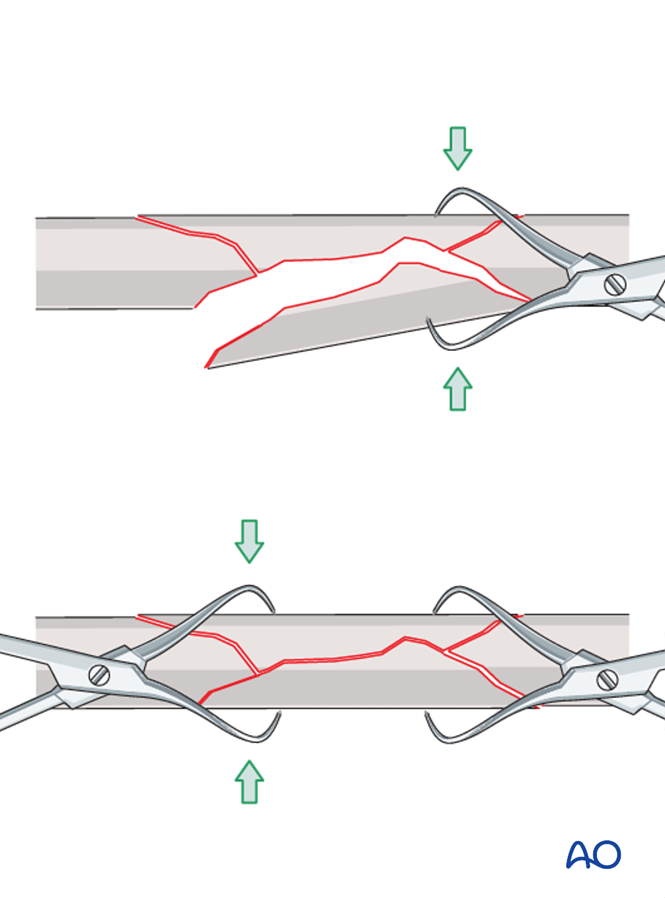 Lag Screw and neutralization plate for Complex diaphyseal fractures ...