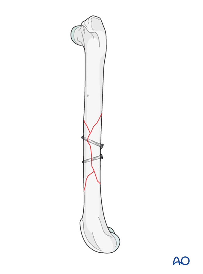 Lag Screw and neutralization plate for Complex diaphyseal fractures ...