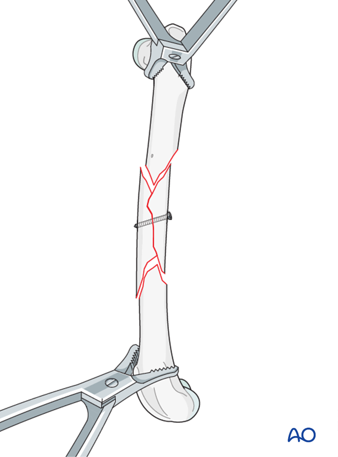 Lag Screw and neutralization plate for Complex diaphyseal fractures ...