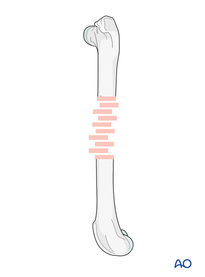 Plate and rod for Diaphyseal fractures with greater than 1 ...