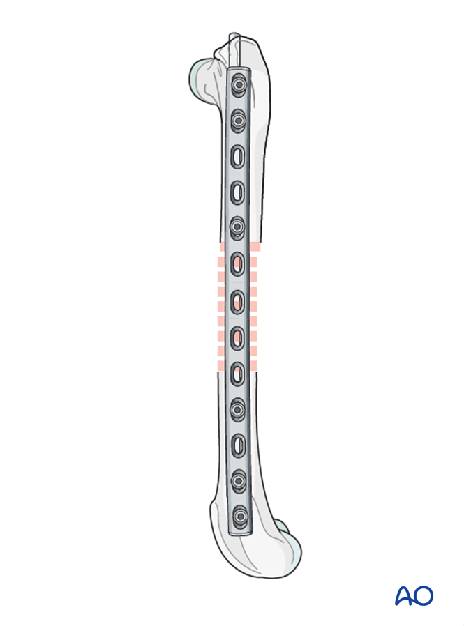 Plate and rod for Diaphyseal fractures with greater than 1 ...