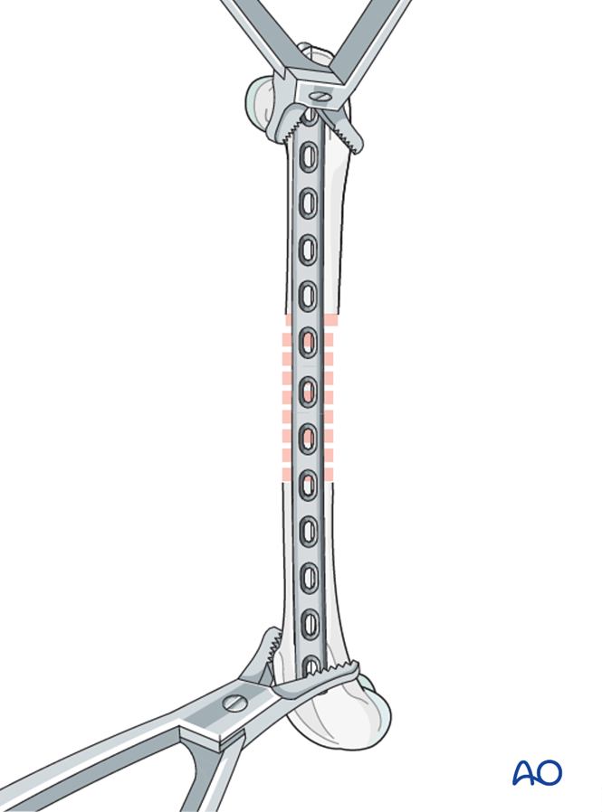 Plate and rod for Diaphyseal fractures with greater than 1 ...