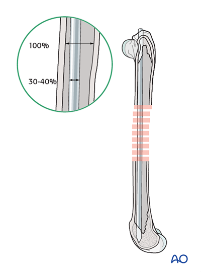 Plate and rod for Complex fractures with non- reconstructible wedges ...