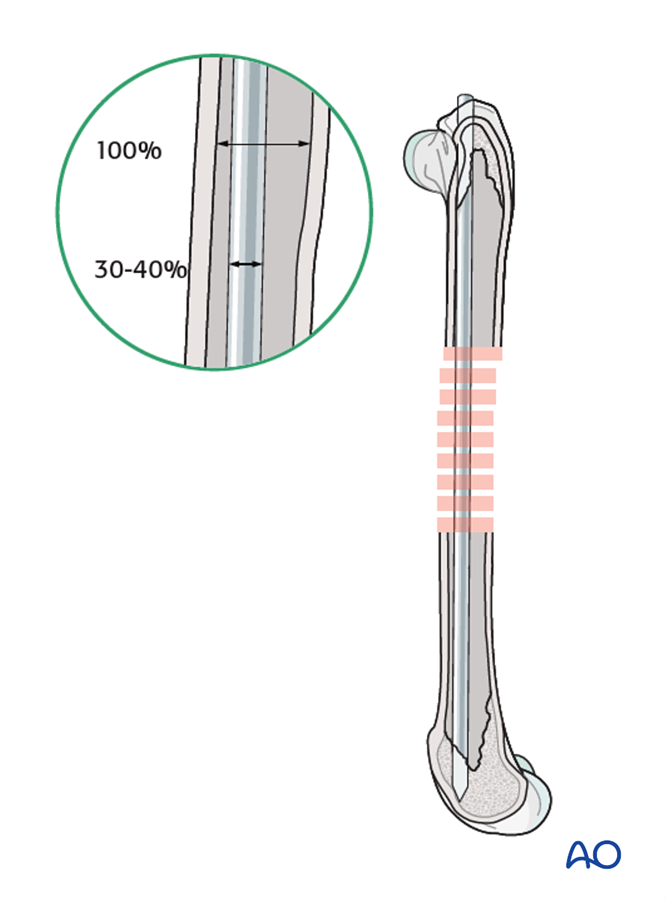 Plate and rod for Diaphyseal fractures with greater than 1 ...