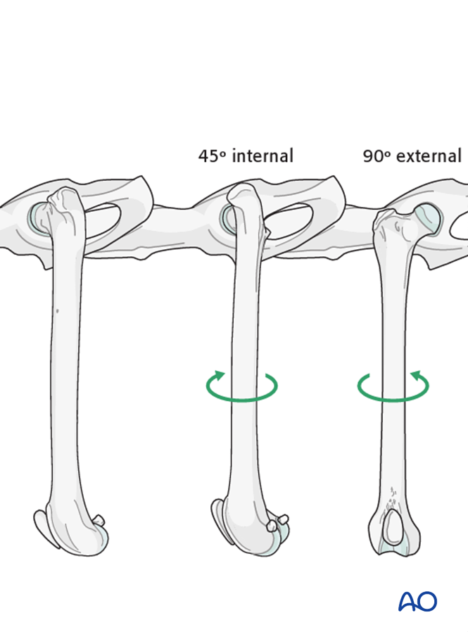 Bridging plate for Diaphyseal fractures with greater than 1 ...