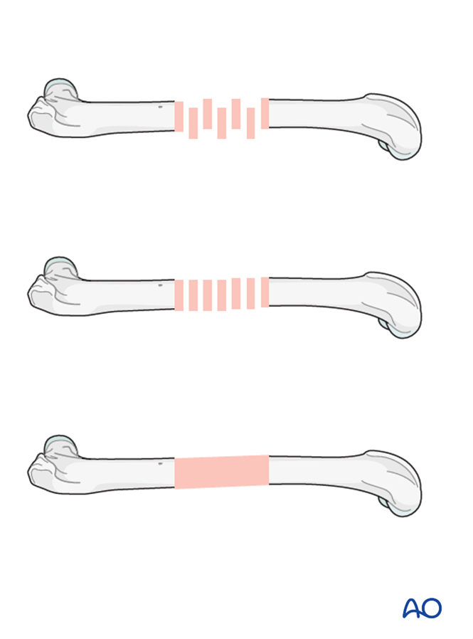 Bridging plate for Diaphyseal fractures with greater than 1 ...