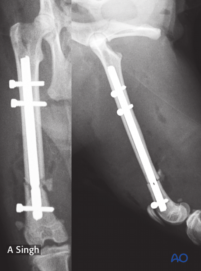 Interlocking nail for Diaphyseal fractures with one or more non ...