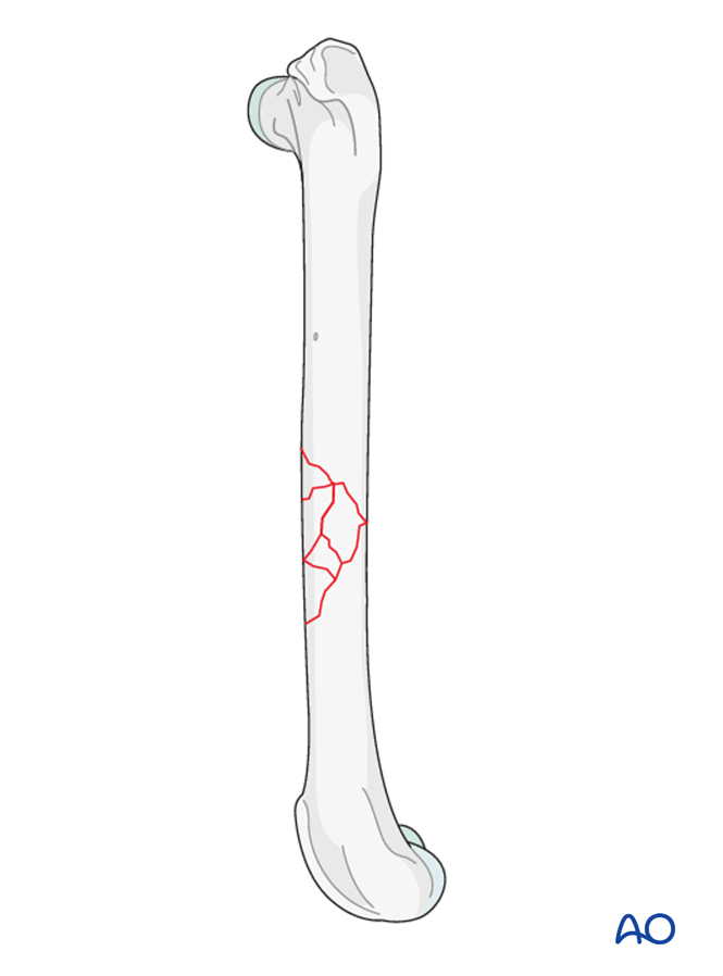 Bridging plate and alternative double plating for Diaphyseal fractures ...