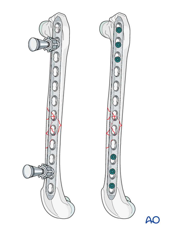 Bridging plate and alternative double plating for Complex fractures ...