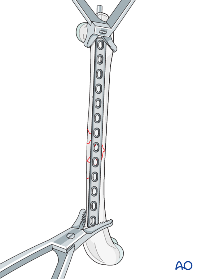 Bridging plate and alternative double plating for Diaphyseal fractures ...