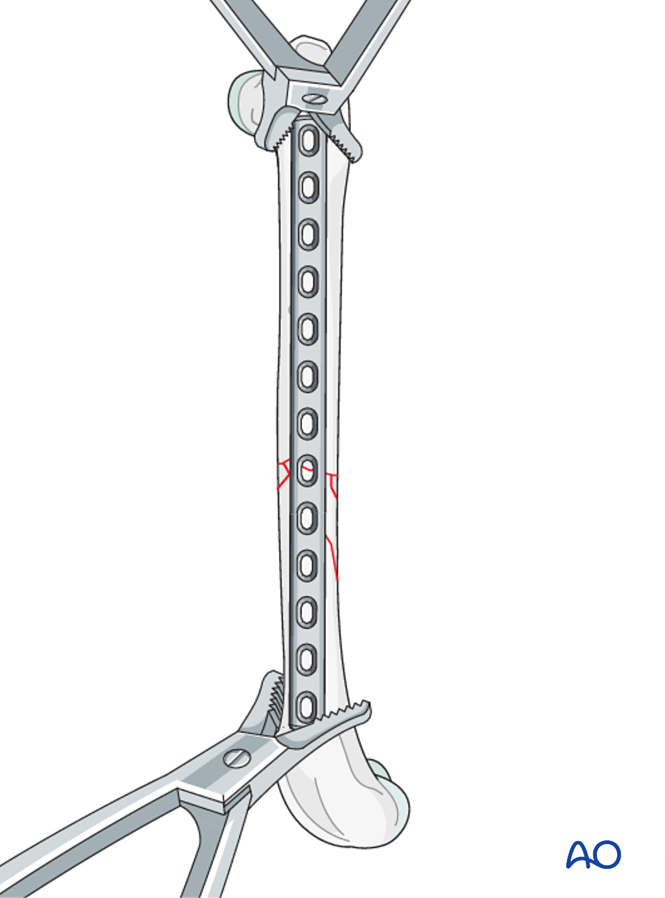 Bridging plate for Diaphyseal fractures with greater than 1 ...