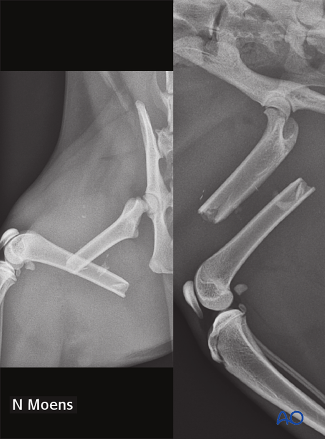 Bridging plate and alternative double plating for Diaphyseal fractures ...