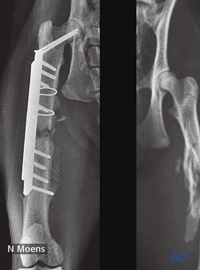 Bridging plate and alternative double plating for Diaphyseal fractures ...