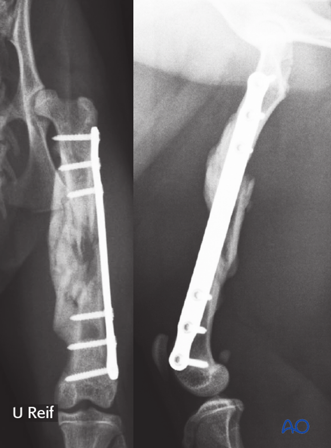 Bridging plate and alternative double plating for Complex fractures ...