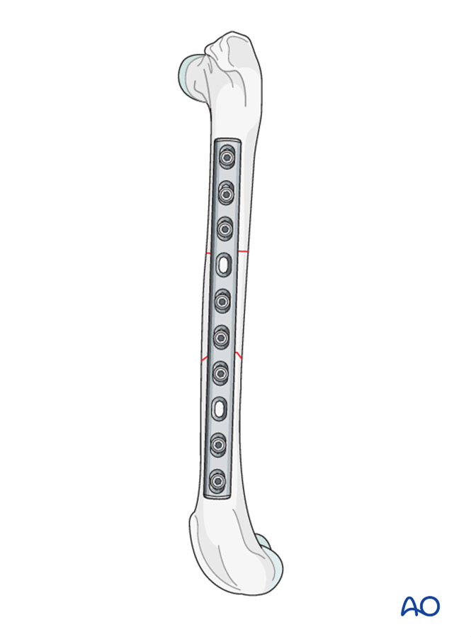 Compression plate for Complex segmental fractures