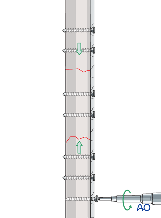 Compression plate for Complex segmental fractures