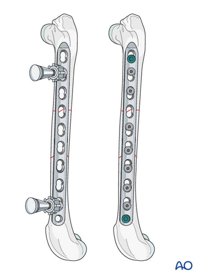 Compression plate for Complex segmental fractures