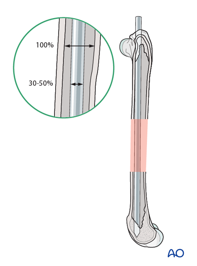 Tie-in technique for Complex fractures with non- reconstructible wedges ...
