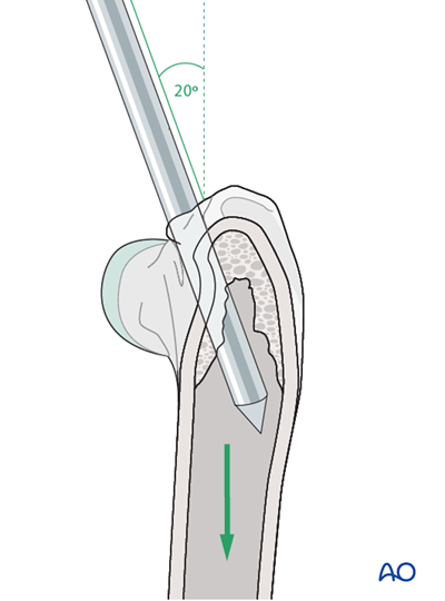Tie-in technique for Complex fractures with non- reconstructible wedges ...