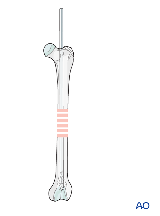 Tie-in technique for Diaphyseal fractures with greater than 1 ...