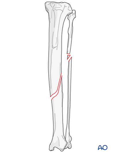 Simple oblique tibial fracture