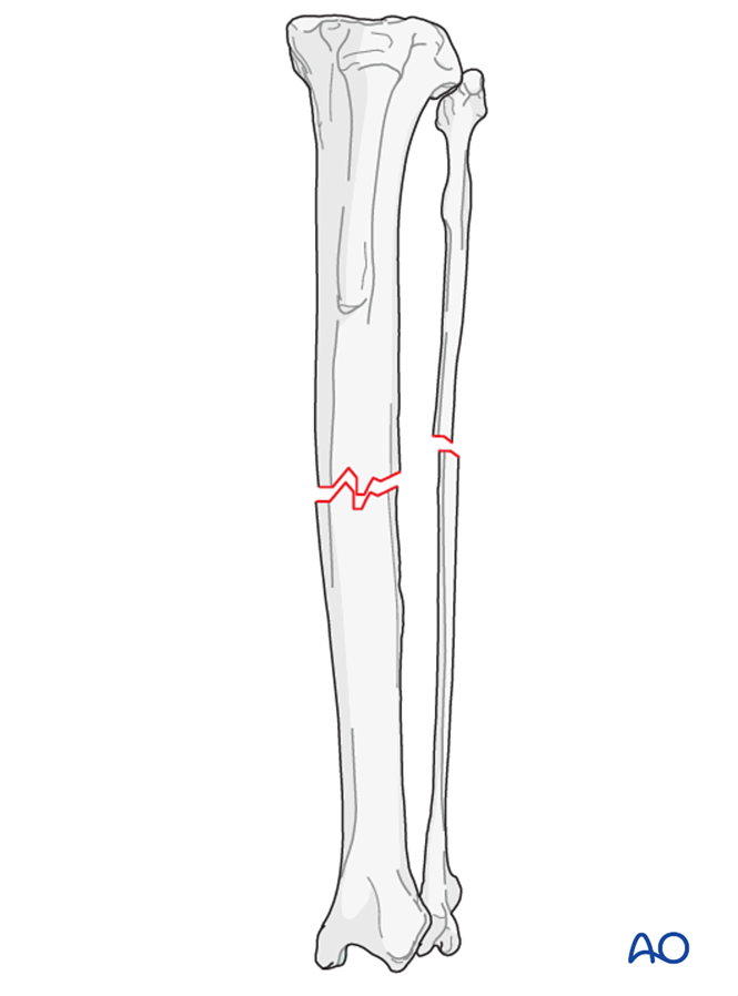 Simple transverse tibial fracture