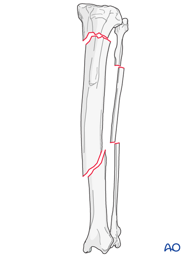 Complex segmental fracture