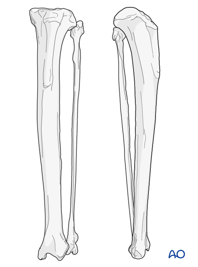 Simple transverse tibial fracture