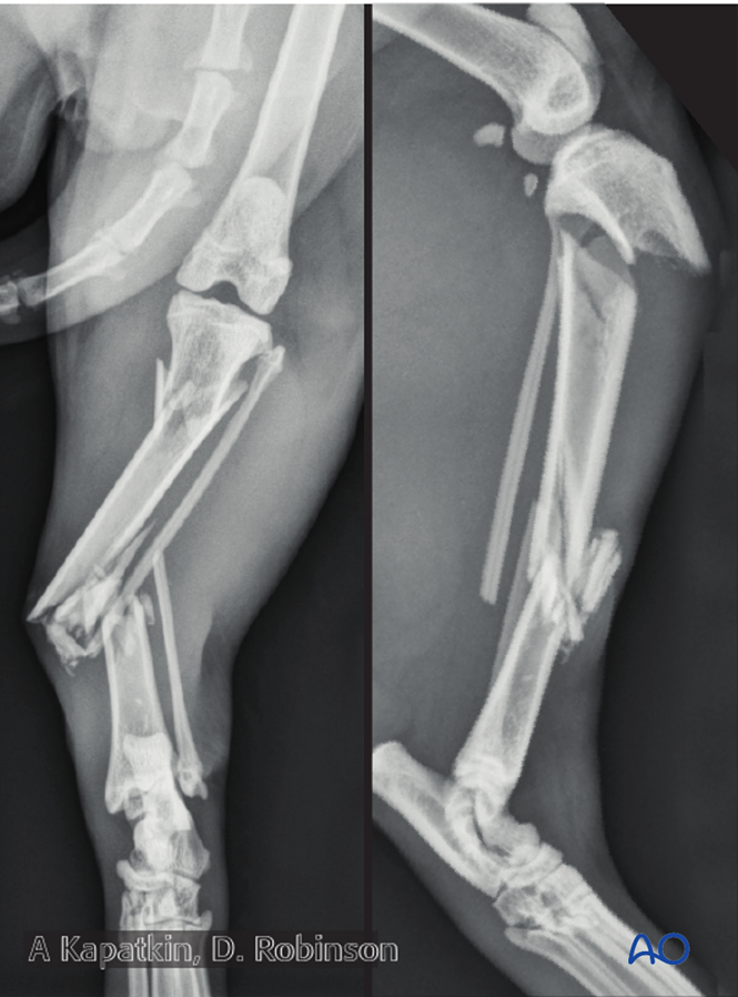 Complex segmental fracture