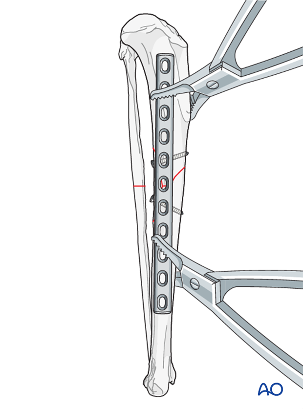 Lag screw or cerclage with neutralization plate for One large reducible ...