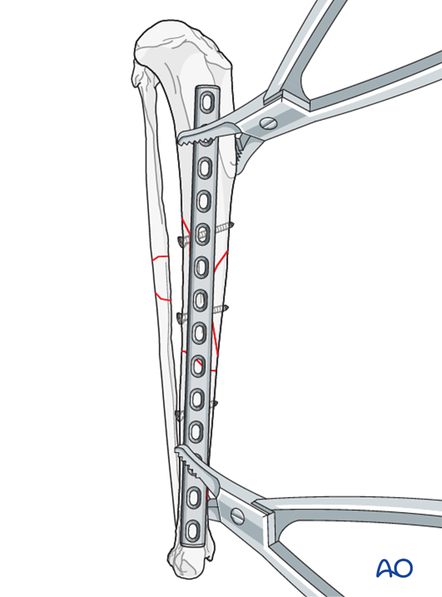 Lag screw with neutralization plate for Complex with reducible wedges ...