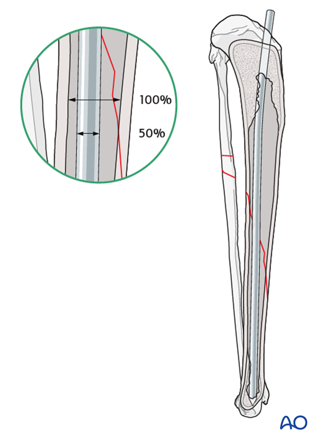 IM pin and cerclage wires for Simple oblique tibial