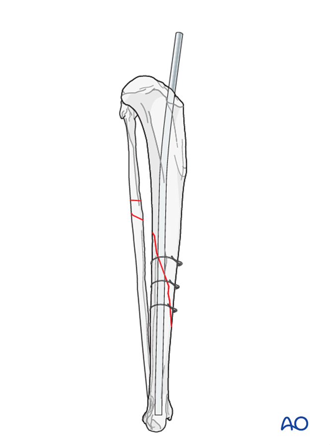 IM pin and cerclage wires for Simple oblique tibial