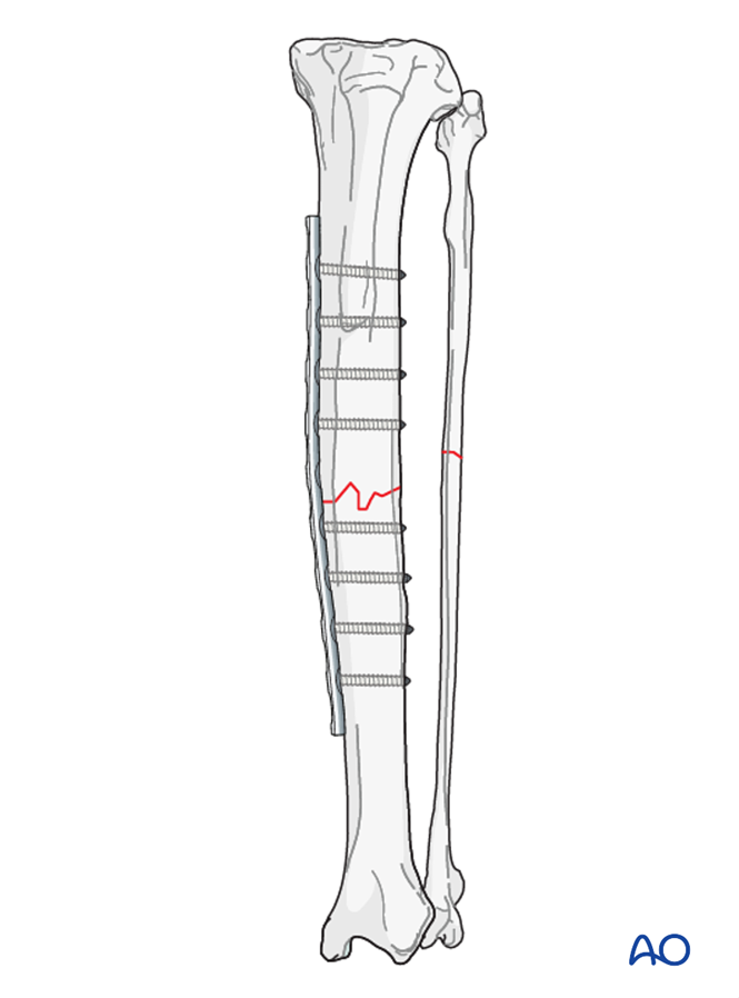 Compression plate for Simple transverse tibial