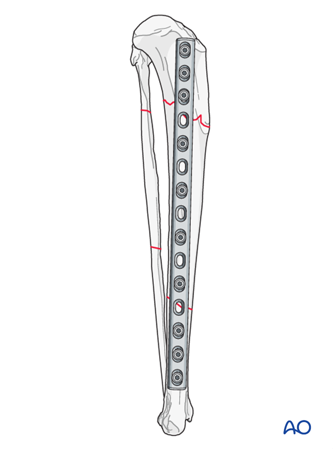 Compression plate for Complex segmental