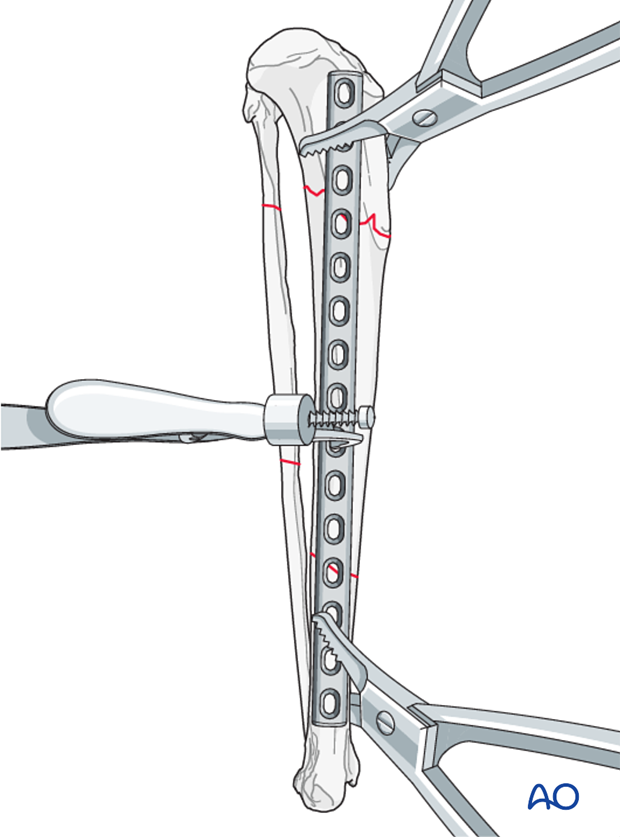 Compression plate for Complex segmental