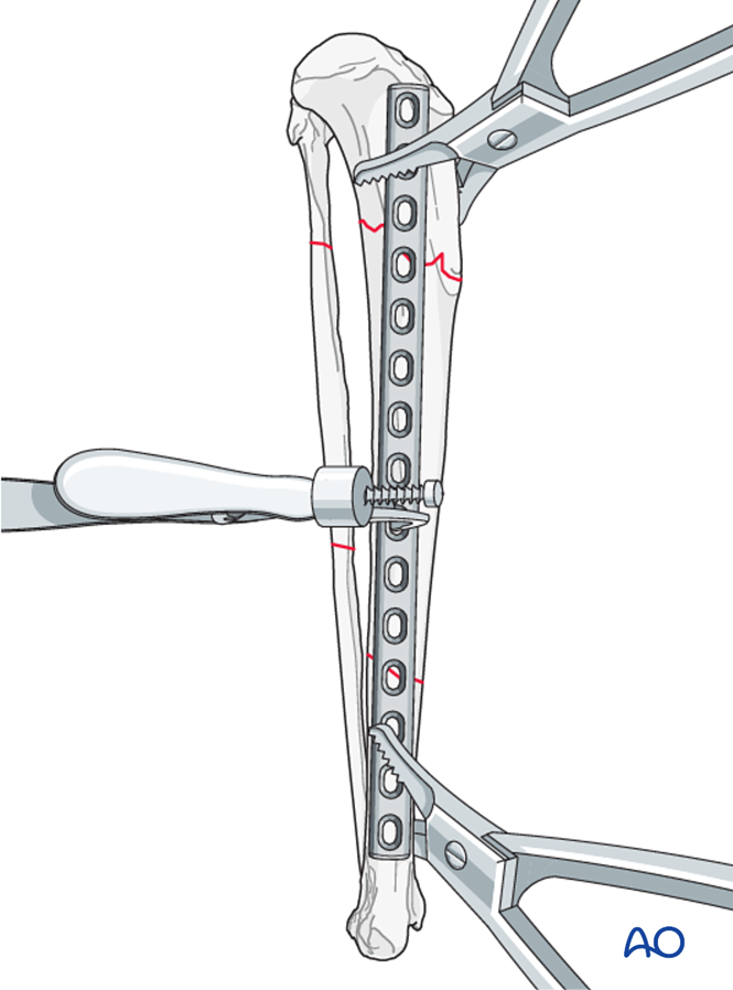 Compression plate for Complex segmental