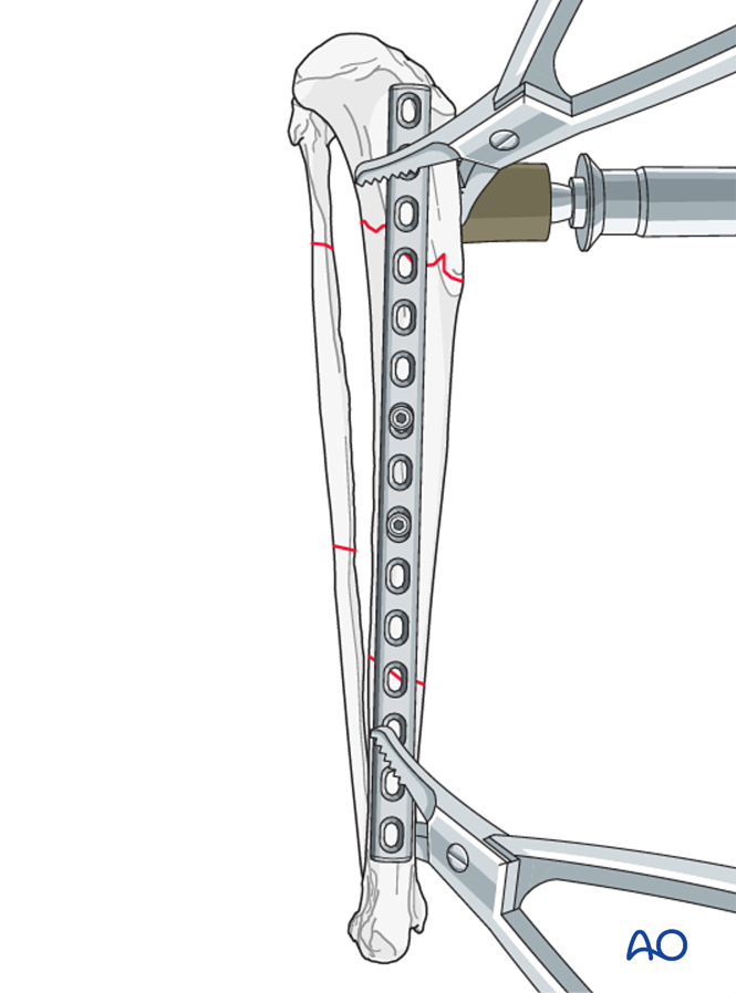 Compression plate for Complex segmental