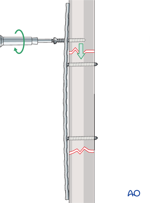 Compression plate for Complex segmental