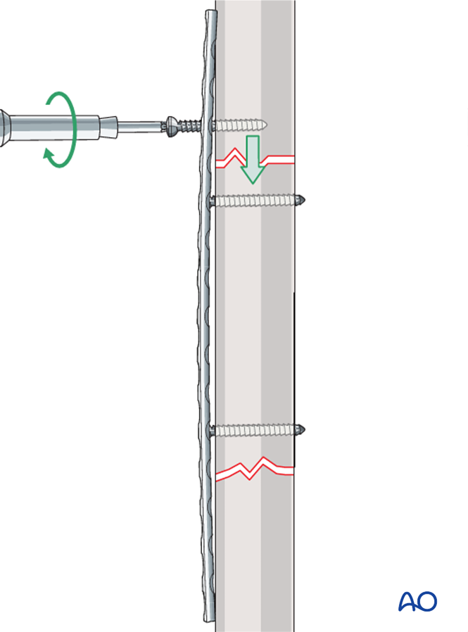 Compression plate for Complex segmental