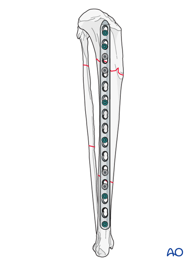 Compression plate for Complex segmental