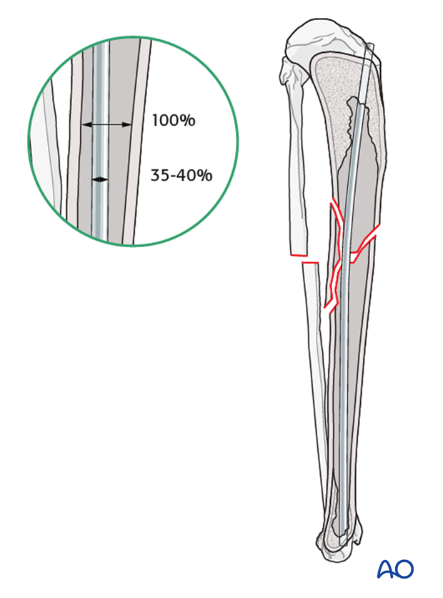 Plate and rod for One large reducible wedge in the tibial diaphysis