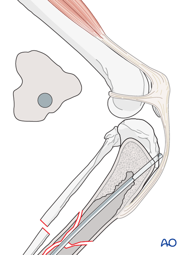 Plate and rod for One large reducible wedge in the tibial diaphysis