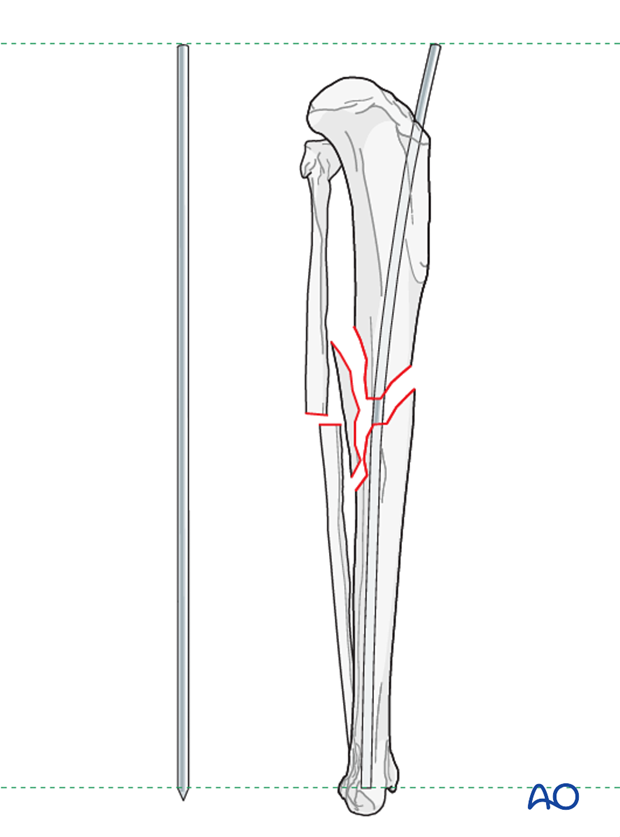 Plate and rod for One large reducible wedge in the tibial diaphysis