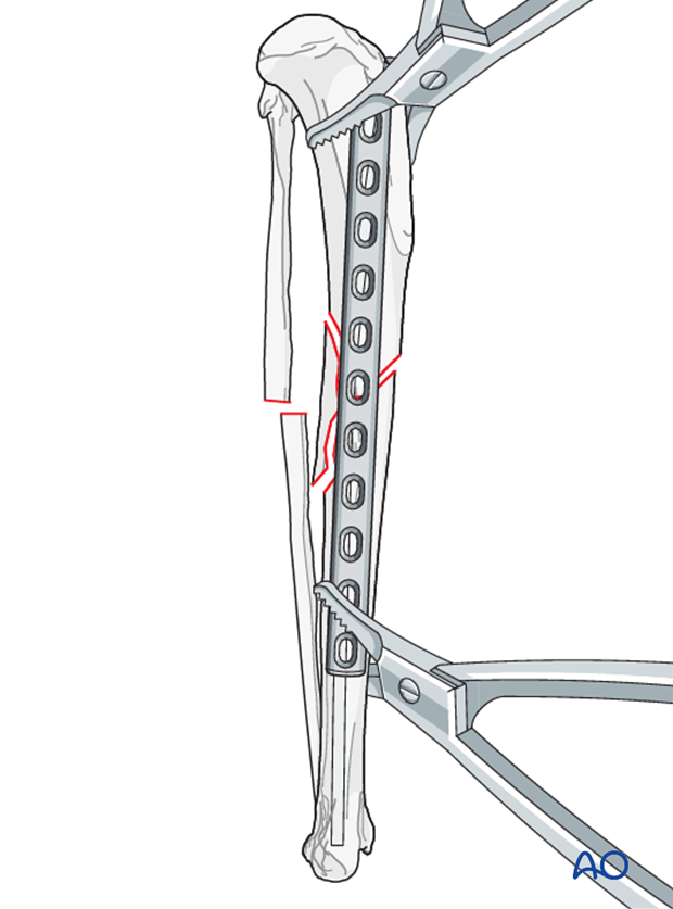 Plate and rod for One large reducible wedge in the tibial diaphysis