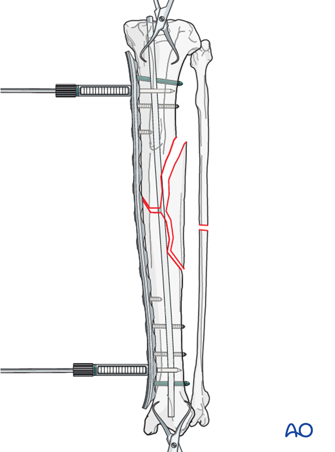 Plate and rod for One large reducible wedge in the tibial diaphysis