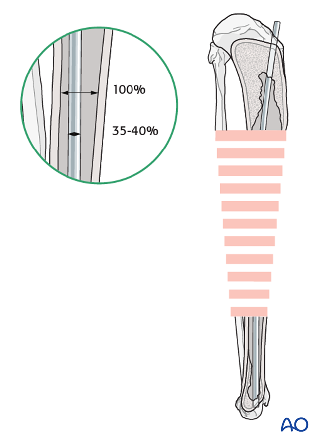 Plate and rod for Complex segmental