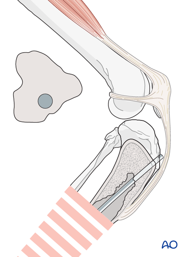 Plate and rod for Complex segmental